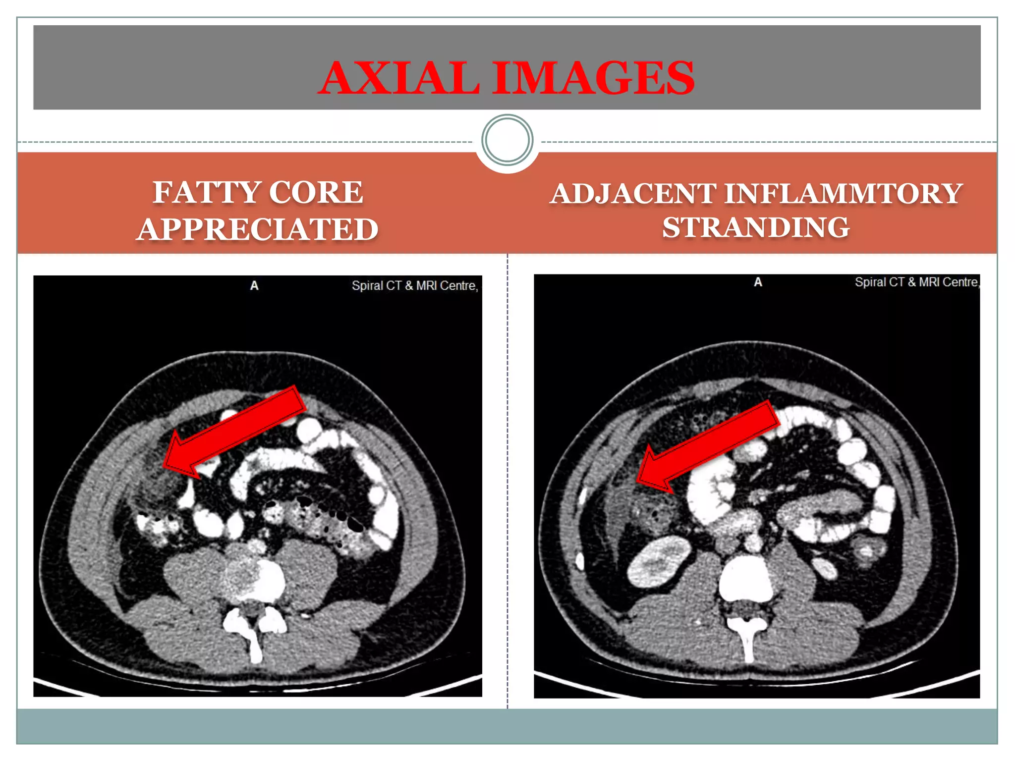 Acute epiploeic appendagitis.pptx2 | PPT