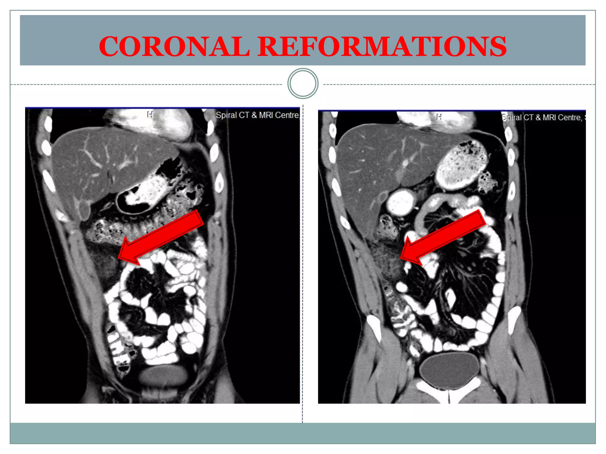 Acute epiploeic appendagitis.pptx2 | PPT