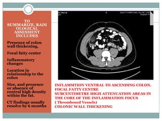 Acute epiploeic appendagitis.pptx2 | PPTX