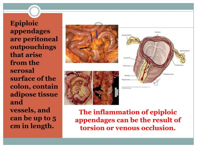 Acute epiploeic appendagitis.pptx2 | PPT