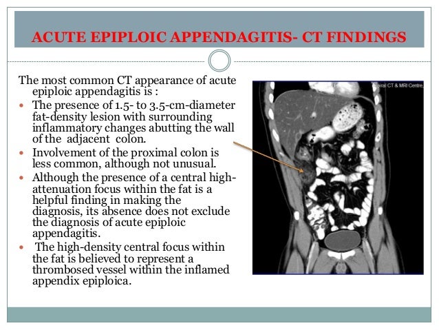 Acute epiploeic appendagitis.pptx2