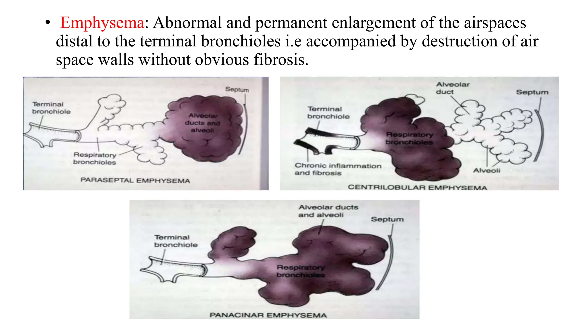 ACUTE EXACERBATION OF CHRONIC OBSTRUCTIVE PULMONARY DISEASE | PPTX