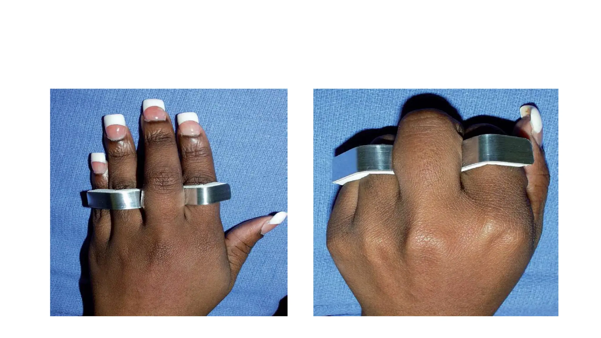 Acute Extensor tendon injuries diagnosis and management.pptx