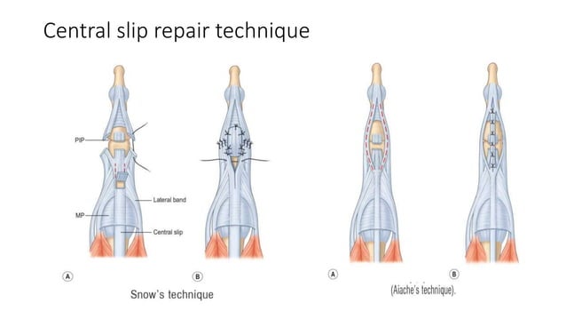 Acute Extensor tendon injuries diagnosis and management.pptx | Death ...