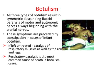 Acute flaccid paralysis afp ‫‬ | PPTX
