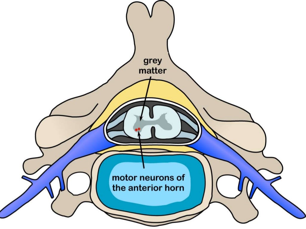 Acute flaccid paralysis afp