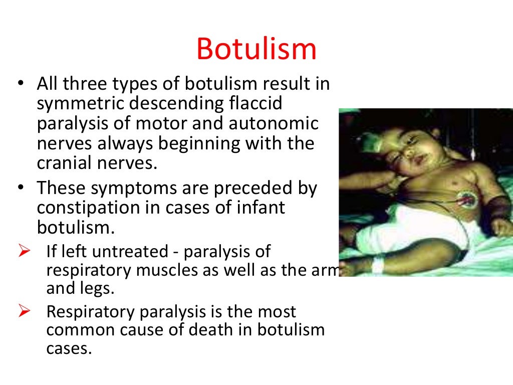 Acute flaccid paralysis afp