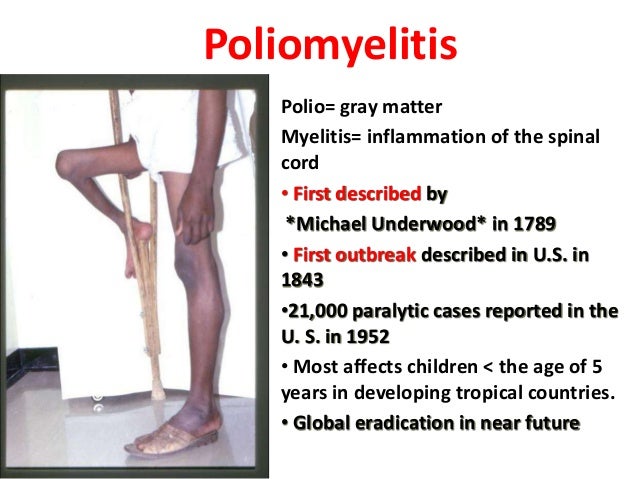 دمحمد ابوندىAcute flaccid paralysis afp