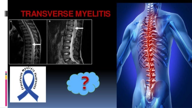Acute Flaccid Paralysis Polioandtm