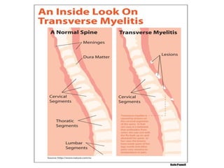 acute flacid paralysis approach-2.pptx