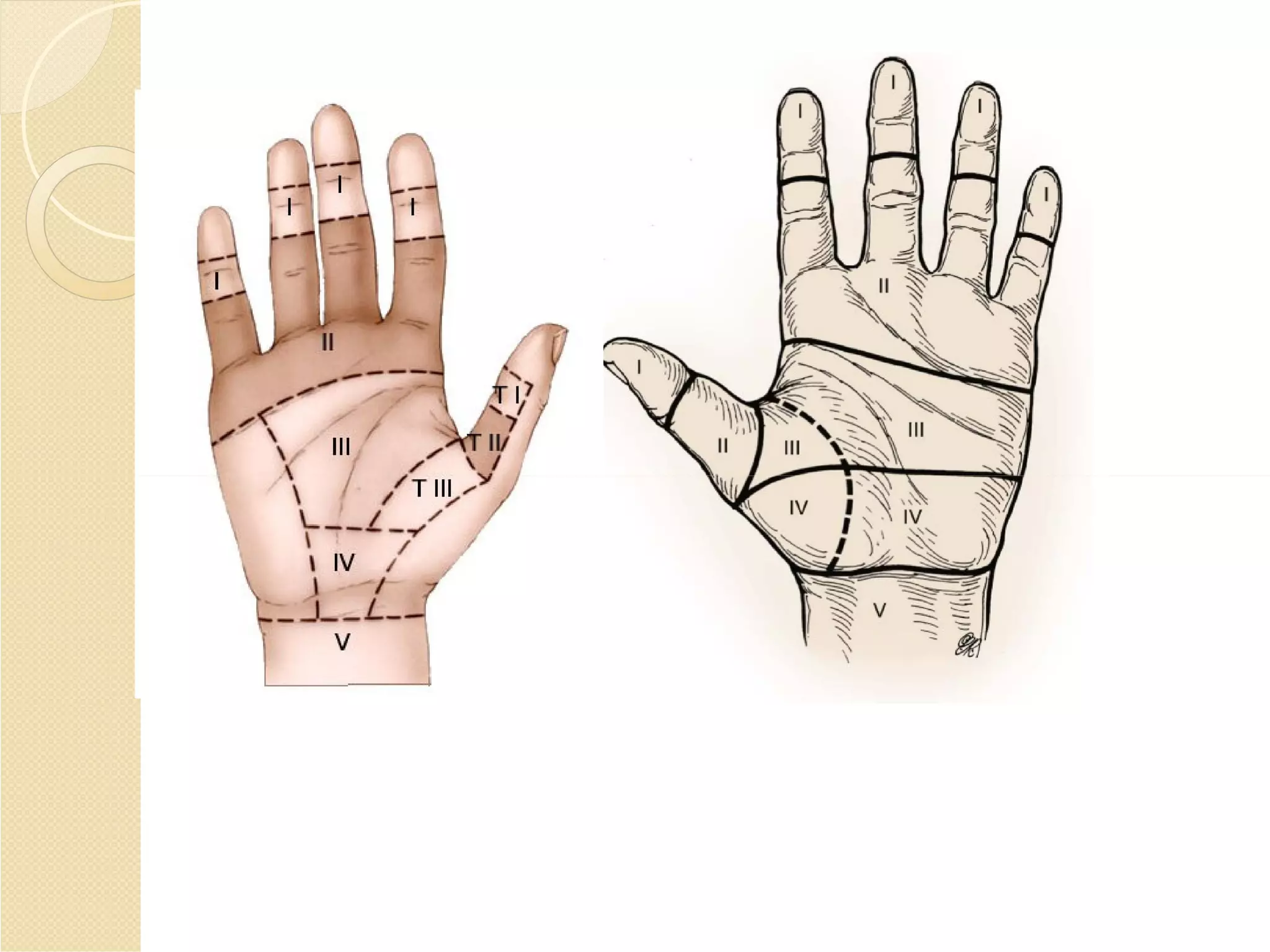 Acute flexor tendon injuries z 1 | PDF