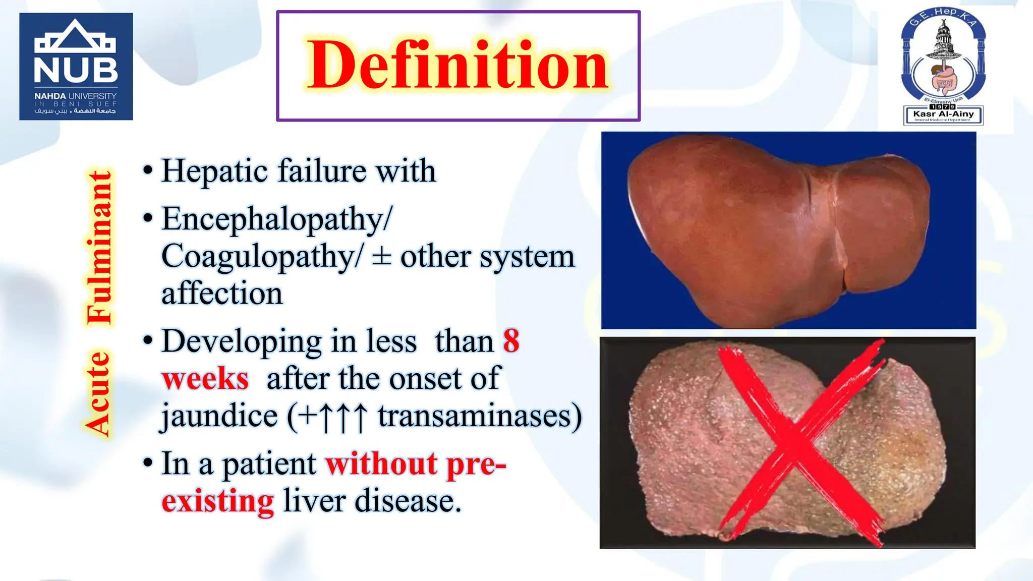 Acute (Fulminant) Liver Failure For Undergraduate.pdf