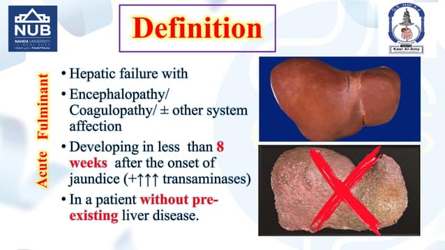 Acute (Fulminant) Liver Failure For Undergraduate.pdf