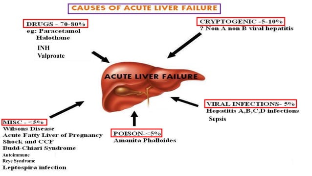 Acute (Fulminant) Liver Failure For Undergraduate.pdf
