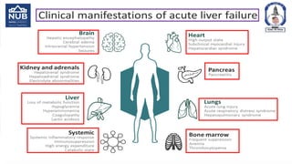 Acute (Fulminant) Liver Failure For Undergraduate.pdf