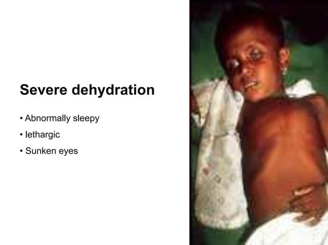 ACUTE PEDIATRIC GASTROENTERITIS | PPTX | Digestive Disorders | Diseases ...