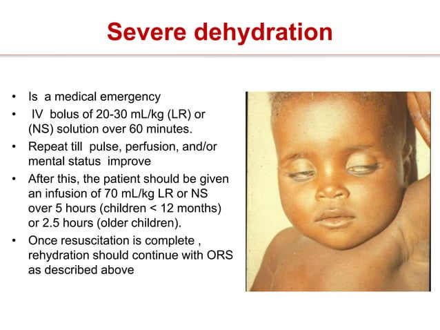 ACUTE PEDIATRIC GASTROENTERITIS | PPTX | Digestive Disorders | Diseases ...
