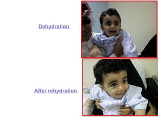 Acute Gastroenteritis Management in Paediatric Patients | PPTX