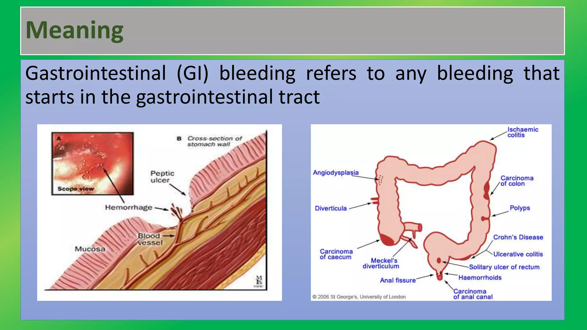 Acute GI bleed | PPTX