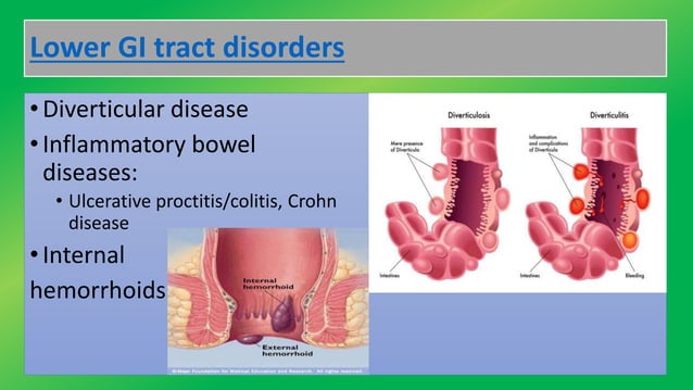 Acute GI bleed | PPTX | Digestive Disorders | Diseases and Conditions