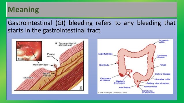 Acute GI bleed
