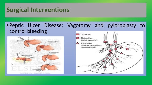 Acute GI bleed