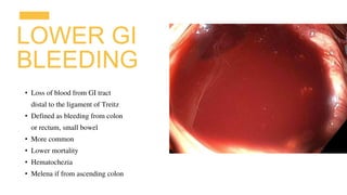 ACUTE GI BLEED presentation em dept bjmc | PPTX