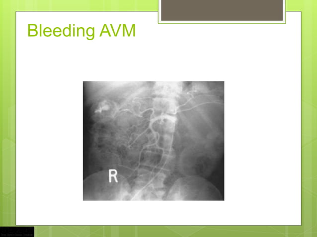 Acute GI Bleedding .ppt