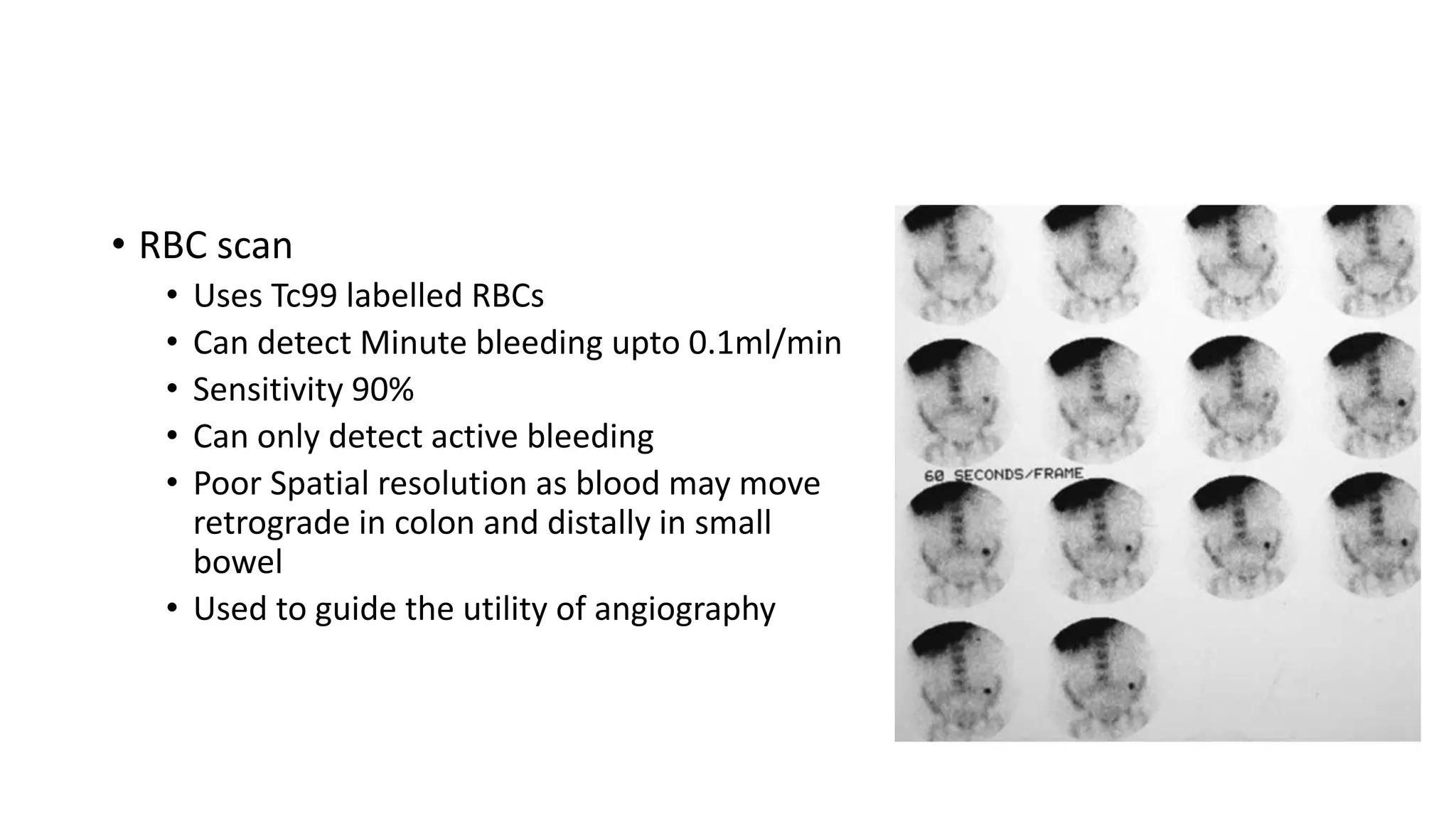Acute gi haemorrhage | PPTX