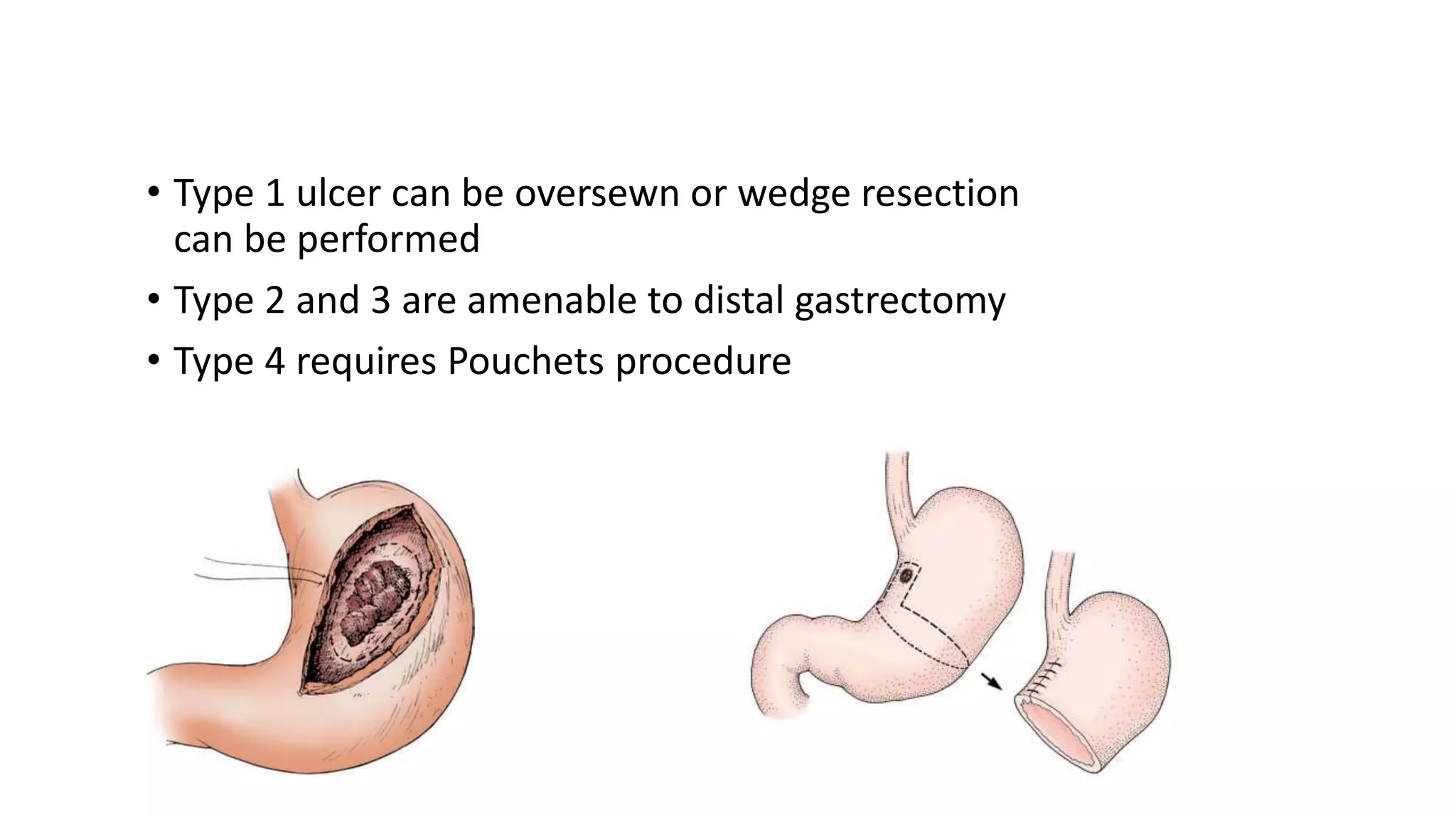 Acute gi haemorrhage | PPTX