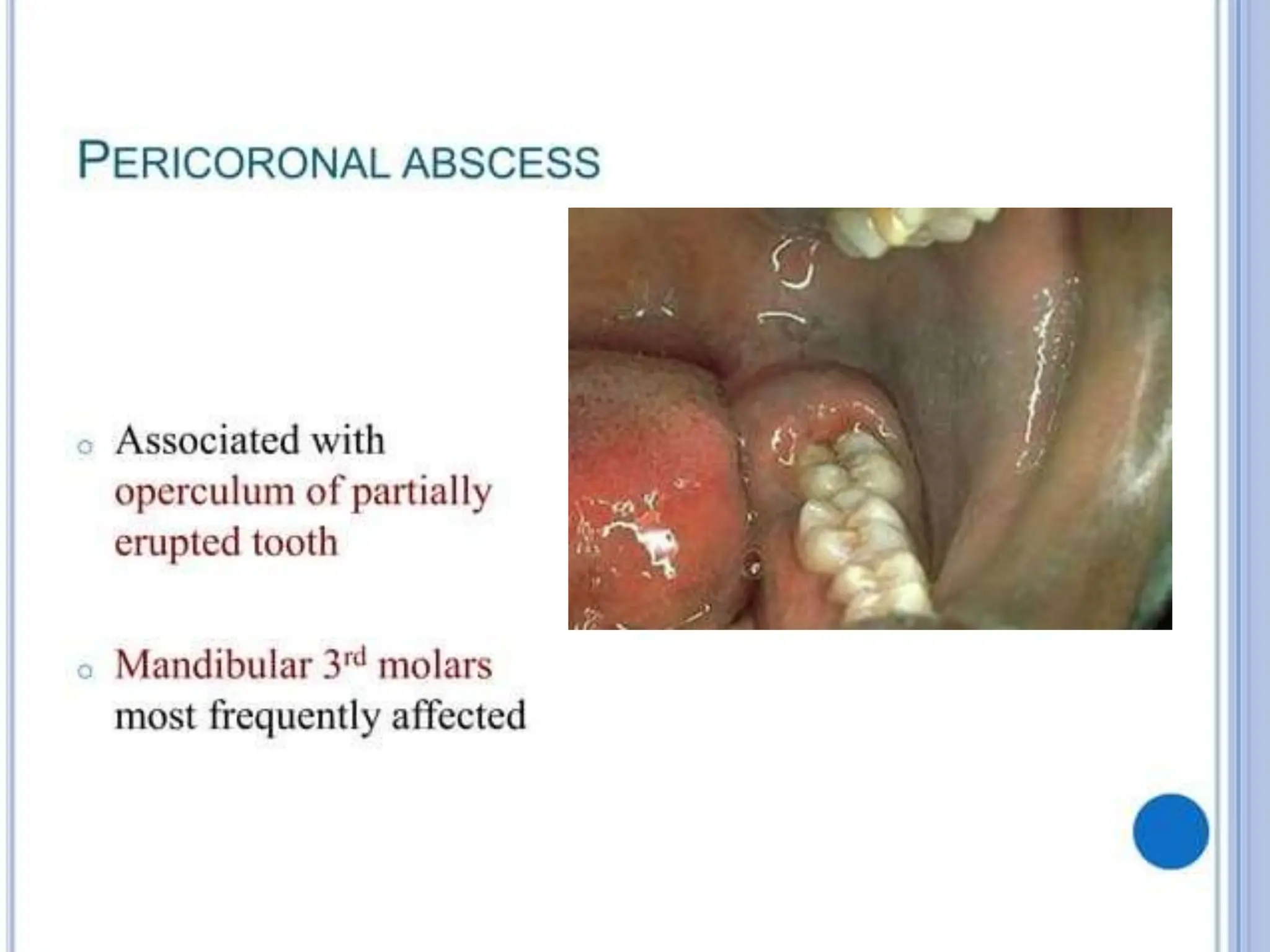 Acute Gingival and Periodontal Infections | PPTX