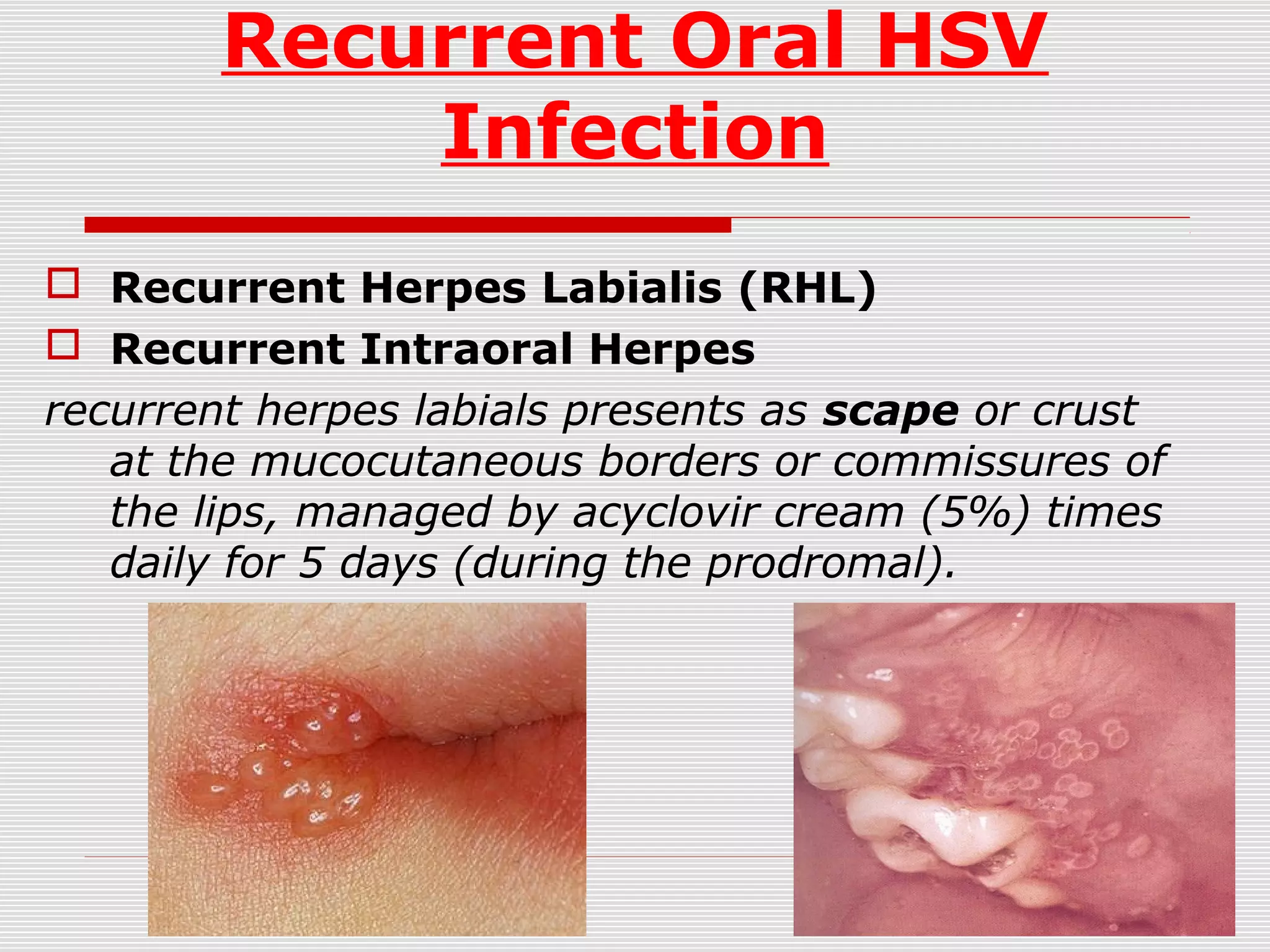 Acute gingival conditions | PPT