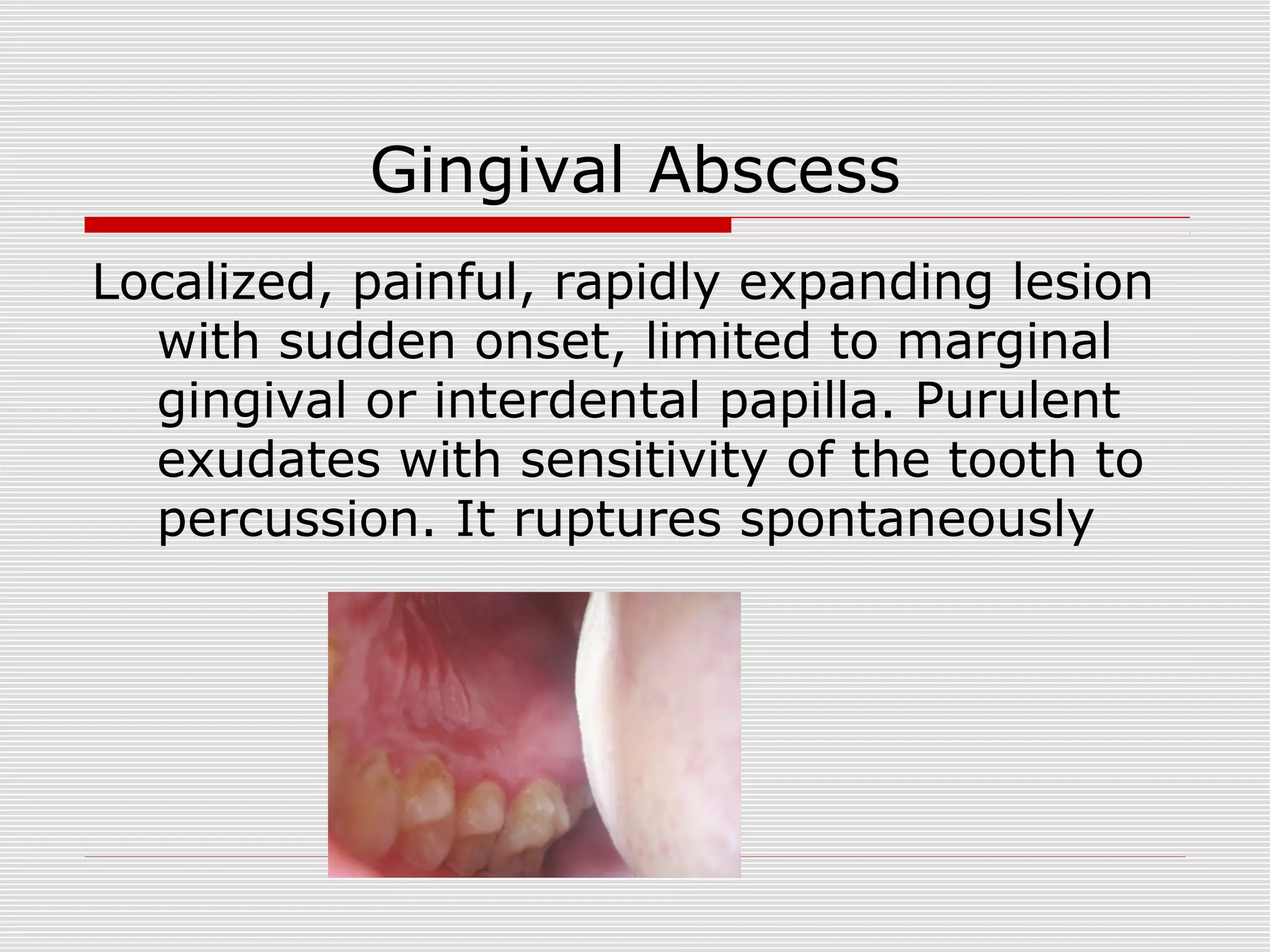 Acute gingival conditions | PPT