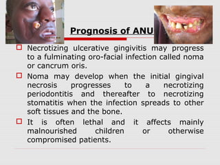 Acute gingival conditions | PPT