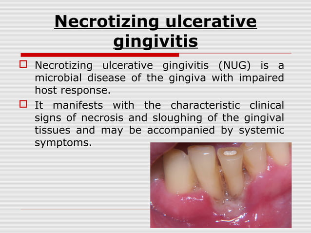 Acute gingival conditions | PPT | Dental Health | Diseases and Conditions