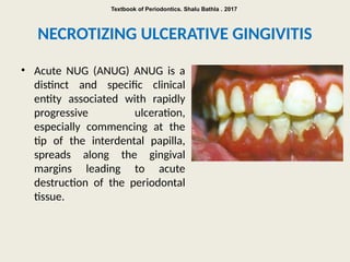 Acute Gingival Conditions.Pptx dentistry | PPTX