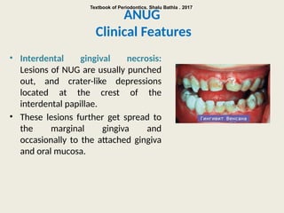 Acute Gingival Conditions.Pptx dentistry | PPTX