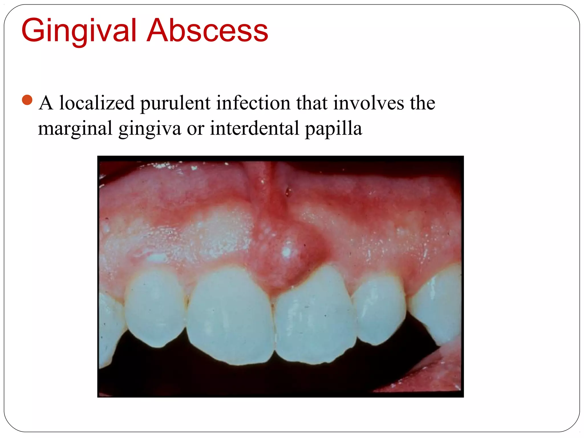 Acute gingival infections- Dr Harshavardhan Patwal | PPT