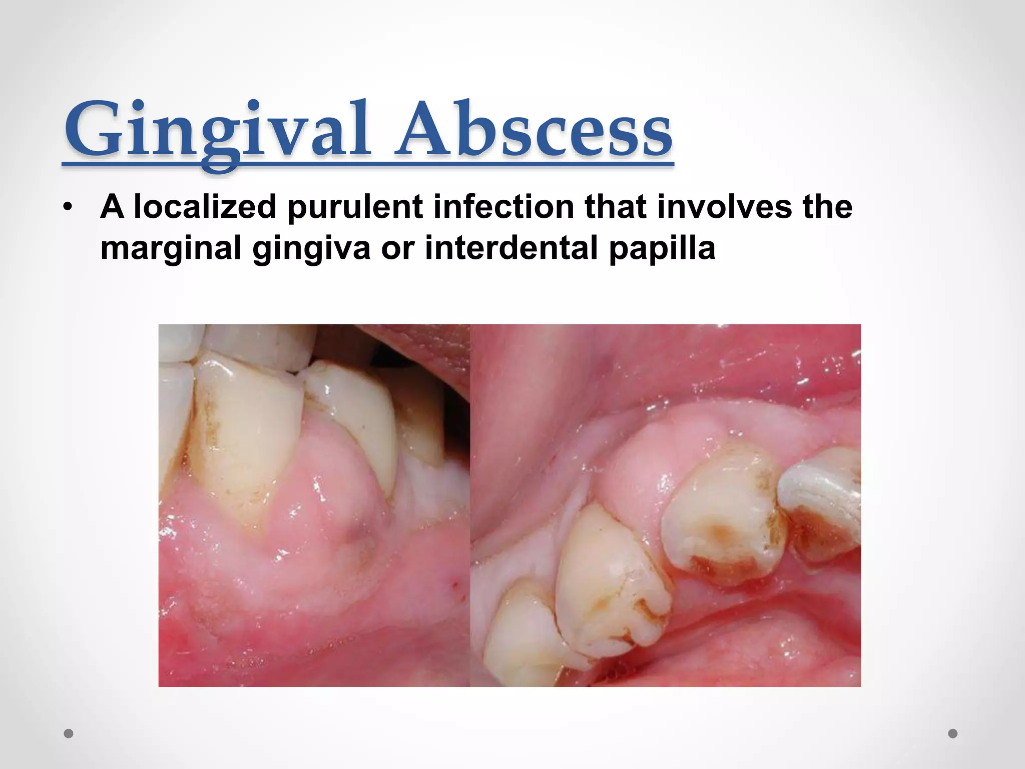 Acute Gingival Infections | PPTX