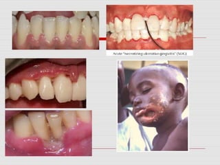 Acute Gingival Infections | PPTX