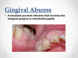 Acute Gingival Infections | PPTX