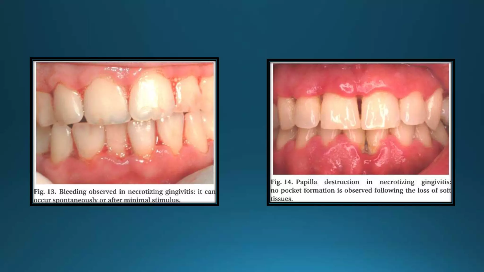 ACUTE GINGIVAL INFECTIONS Based on 2017 Classification.pptx