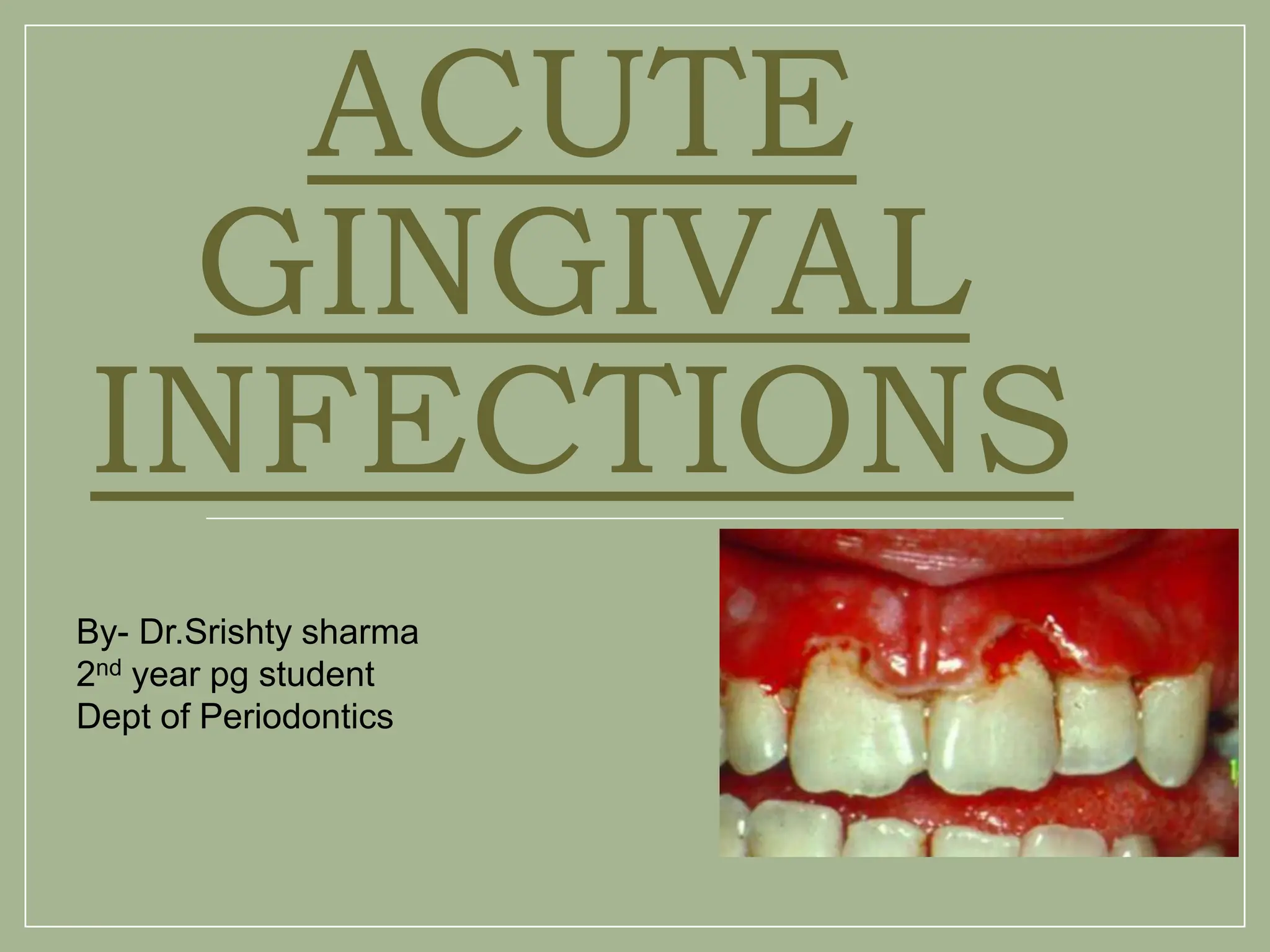 acute gingival infections- symptoms, treatment | PPTX
