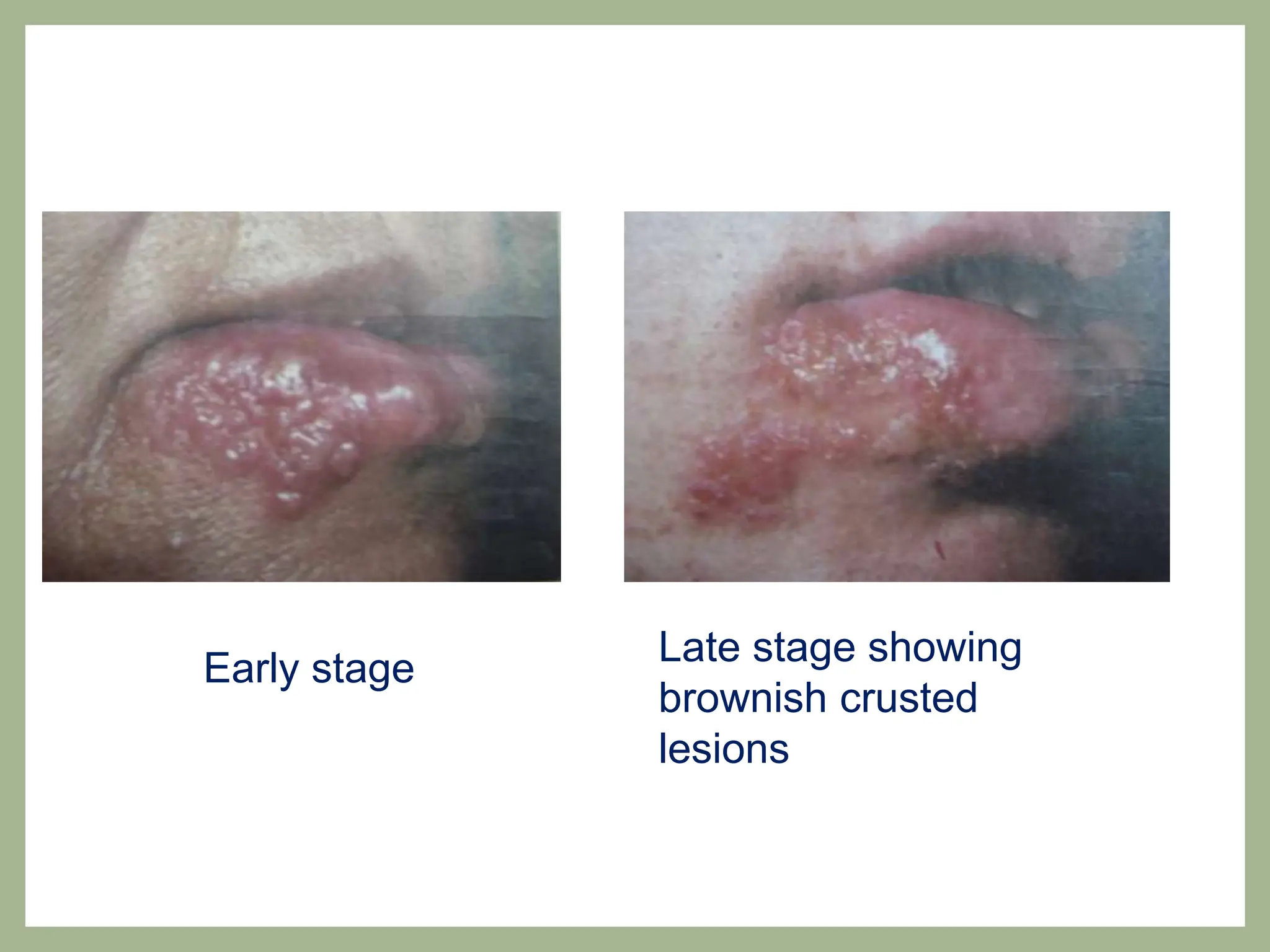 acute gingival infections- symptoms, treatment | PPTX