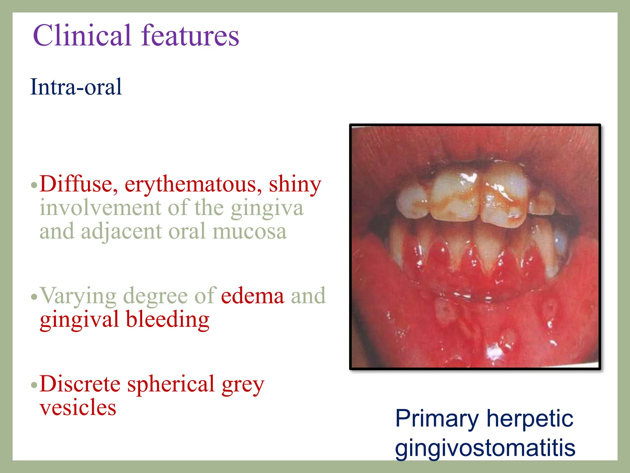 acute gingival infections- symptoms, treatment | PPTX
