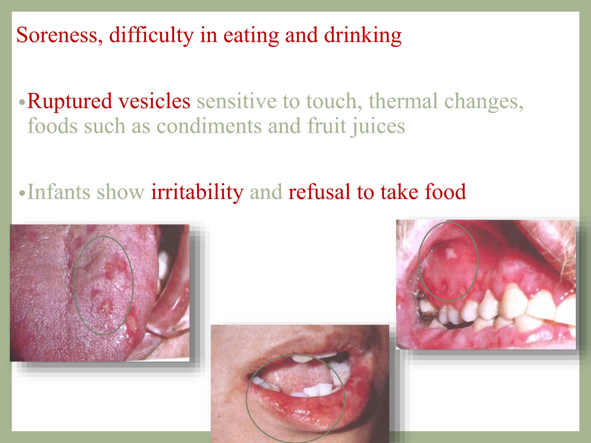 acute gingival infections- symptoms, treatment | PPTX