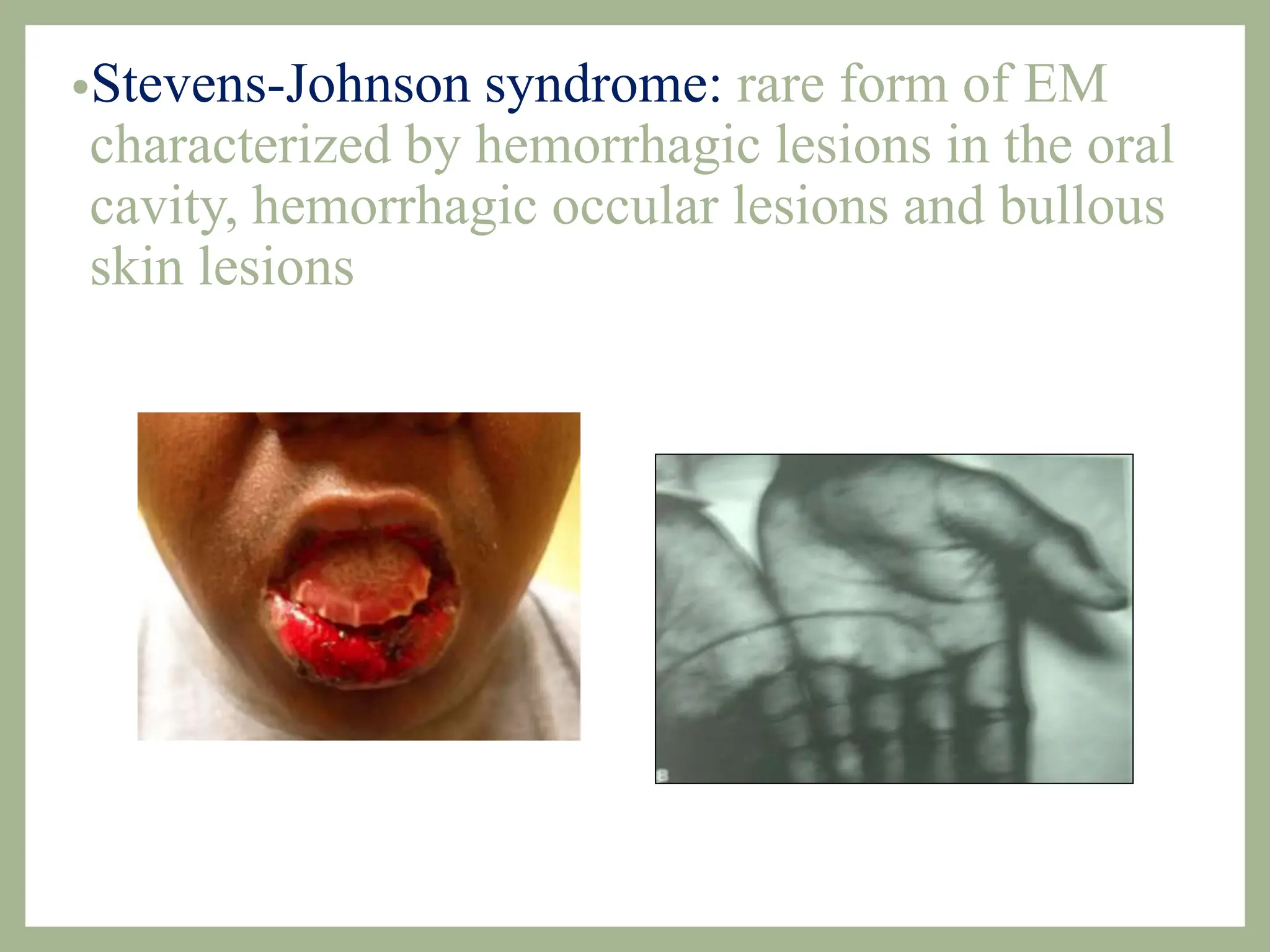 acute gingival infections- symptoms, treatment | PPTX
