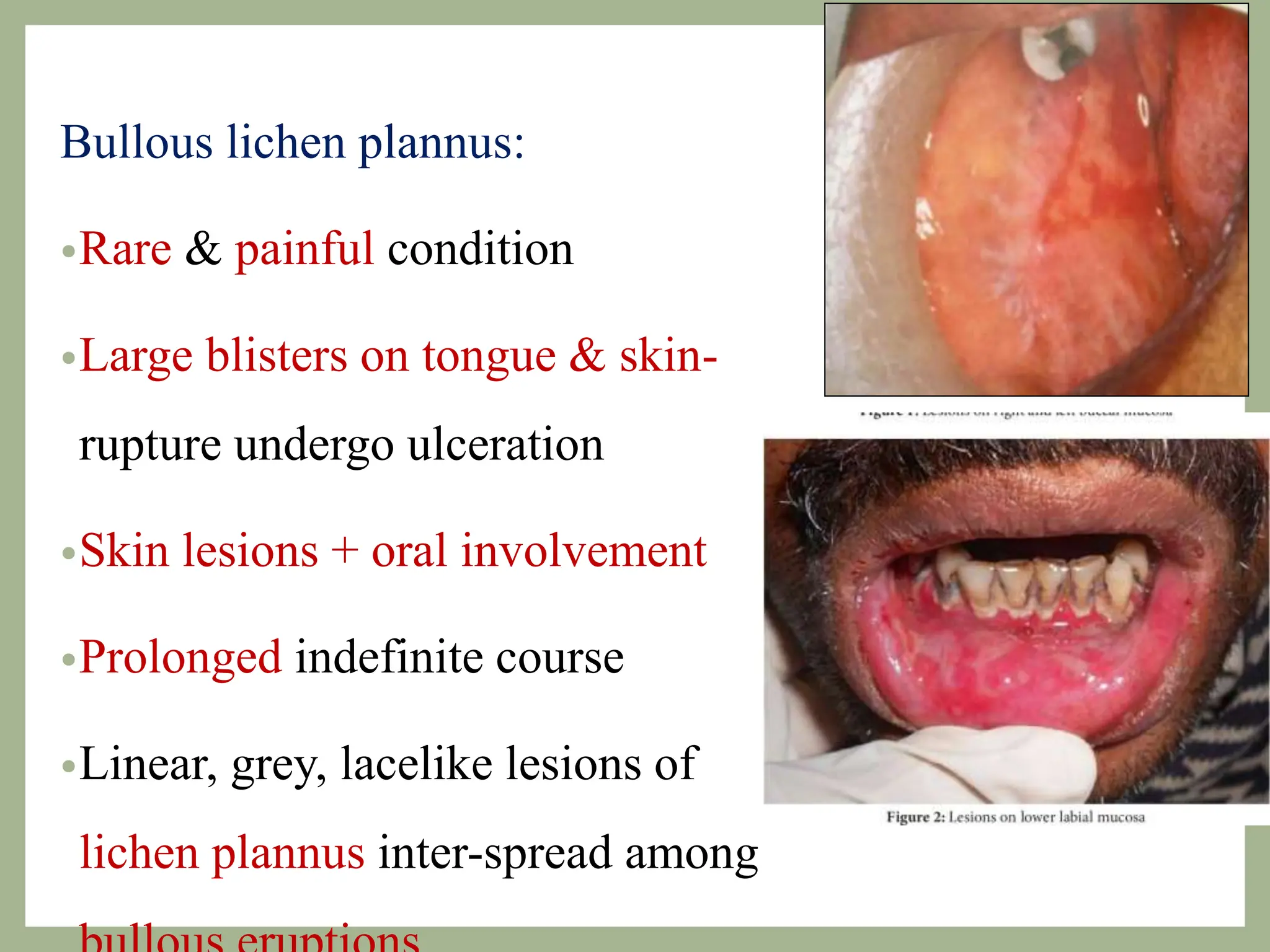 acute gingival infections- symptoms, treatment | PPTX