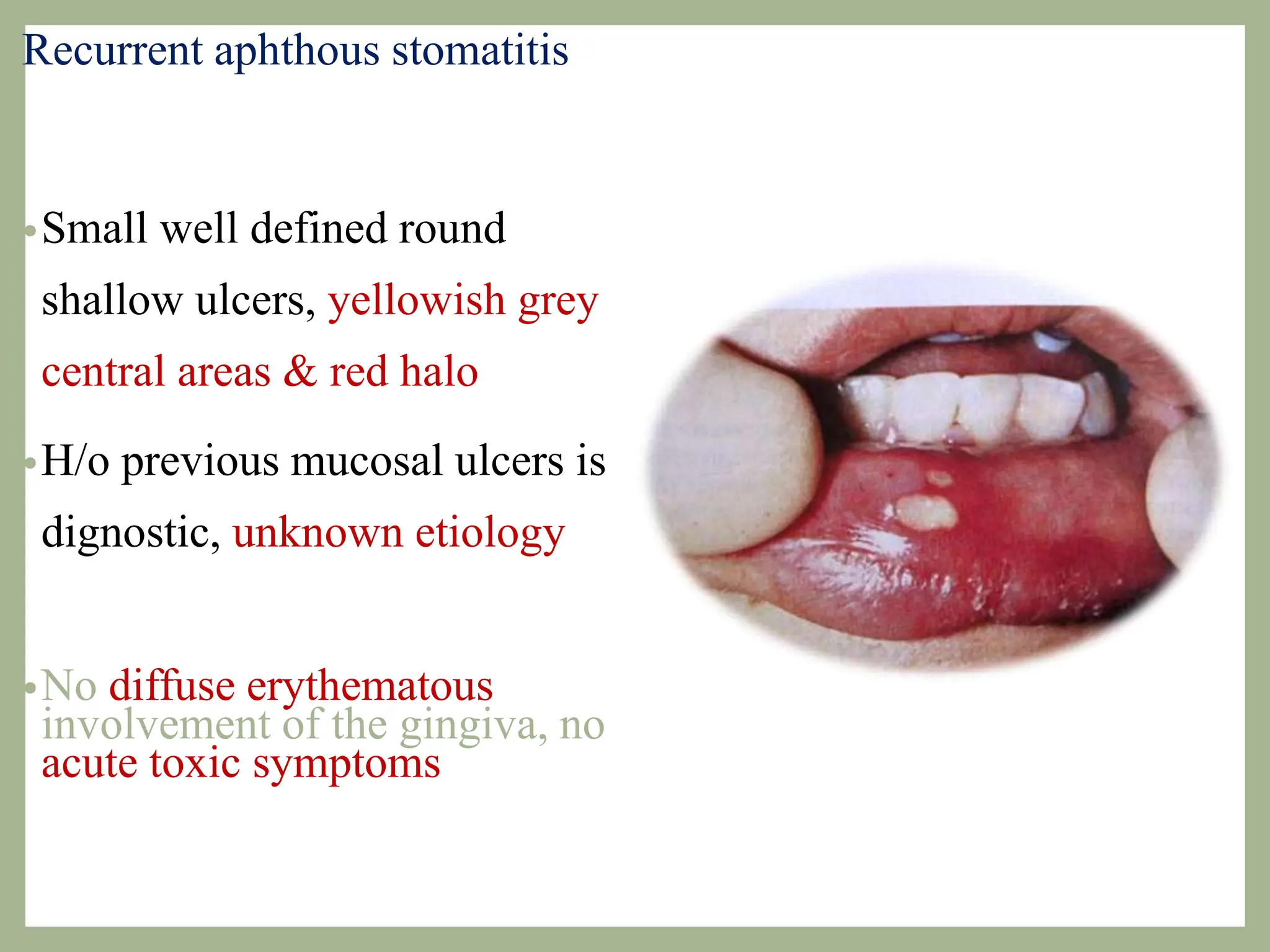 acute gingival infections- symptoms, treatment | PPTX