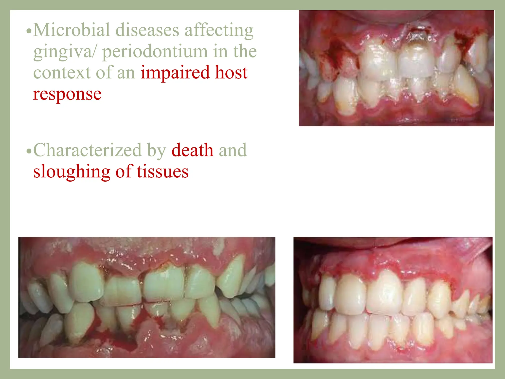 acute gingival infections- symptoms, treatment | PPTX